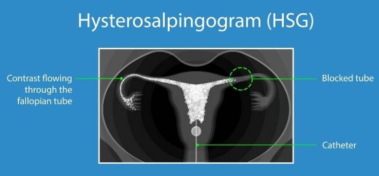 What is an HSG Test? Complete Process & Results